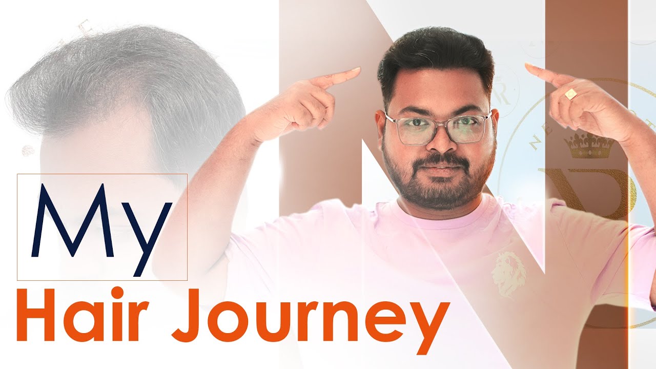 My Hair Transplant Journey In New Roots Clinic Unbelievable Results