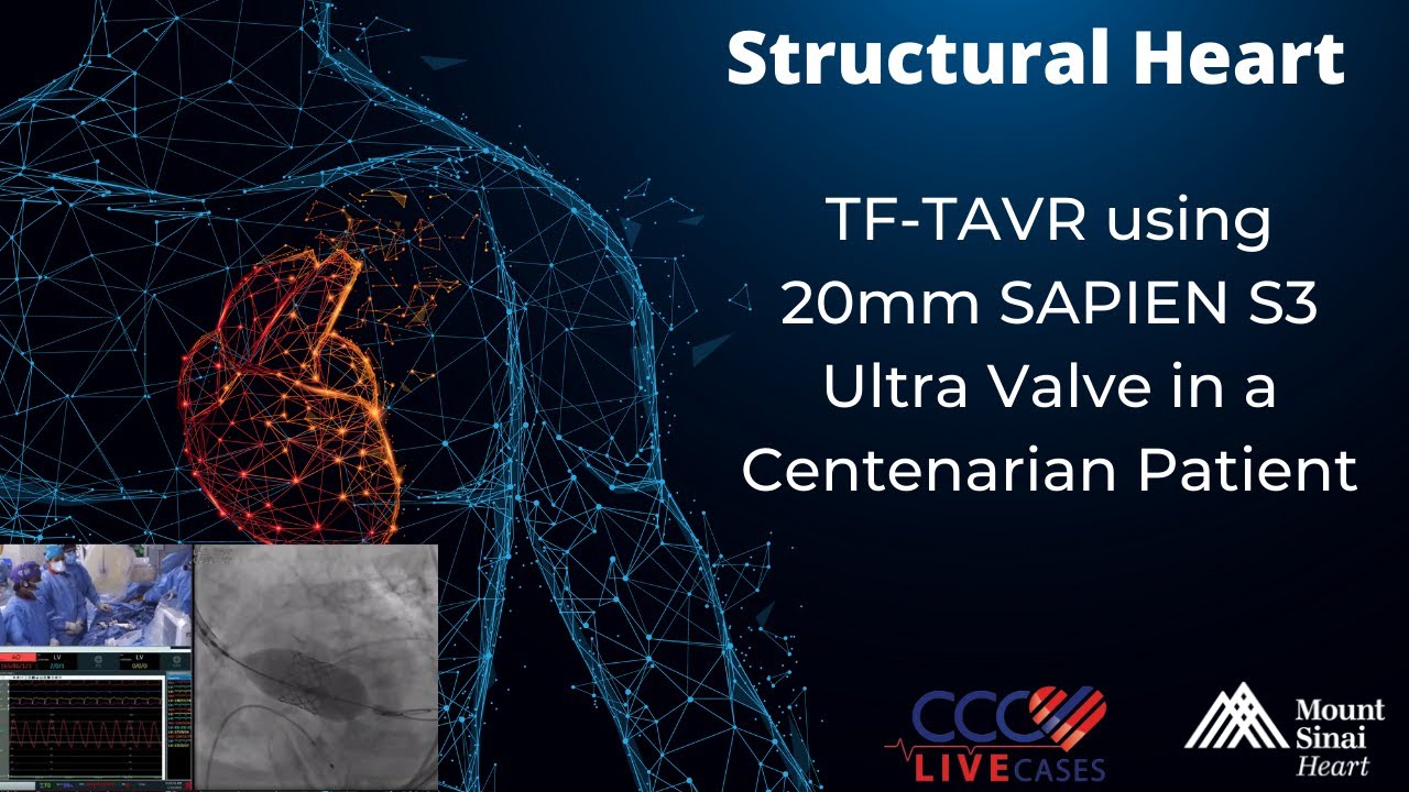 TF-TAVR using 20mm SAPIEN S3 Ultra Valve in a Centenarian Patient - YouTube