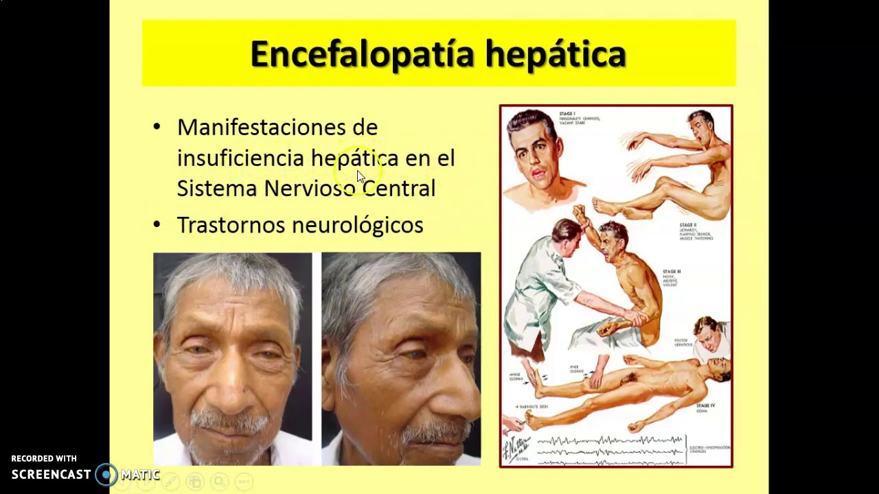 FSPTA 2025. Insuficiencia Hepatica. Parte 2 - YouTube