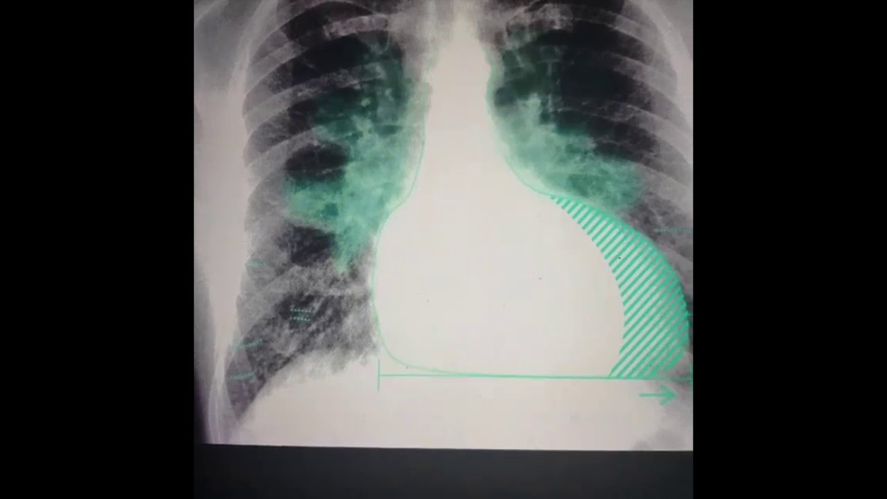 Kerley-B-Linien – Kerley’s A, B, and C Lines – LHAHG