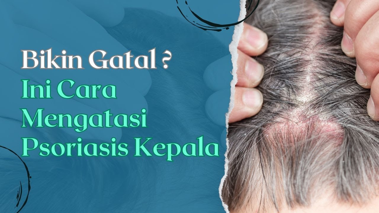 Psoriasis Kulit Kepala : Penyebab dan Cara Mengatasinya #psoriasis # ...