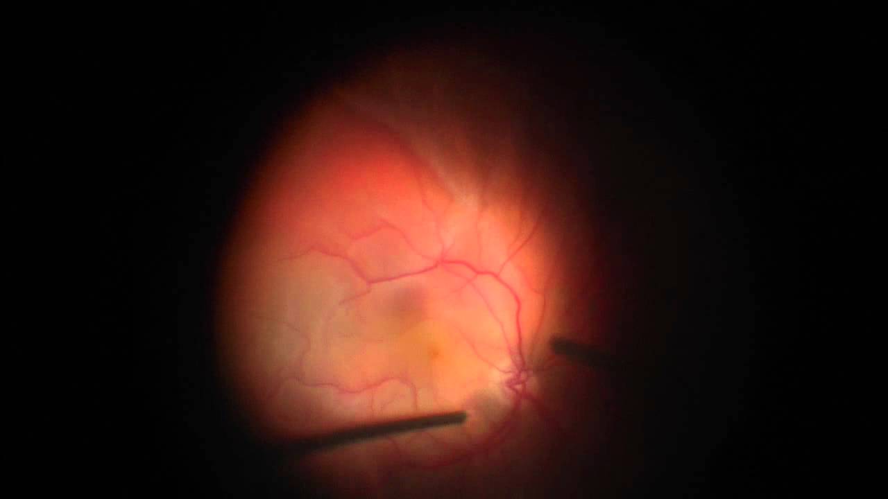Vitrectomy for Repair of Macula Off Retinal Detachment - YouTube