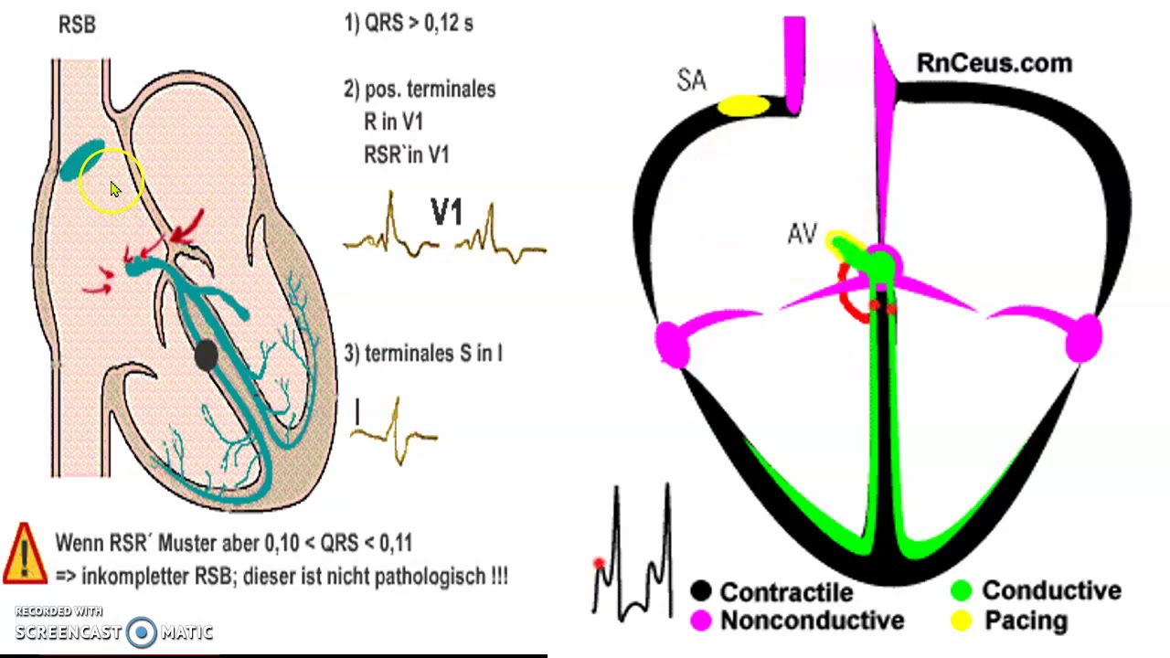 Taquicardias complejo QRS estrecho y ancho pt 1 - YouTube