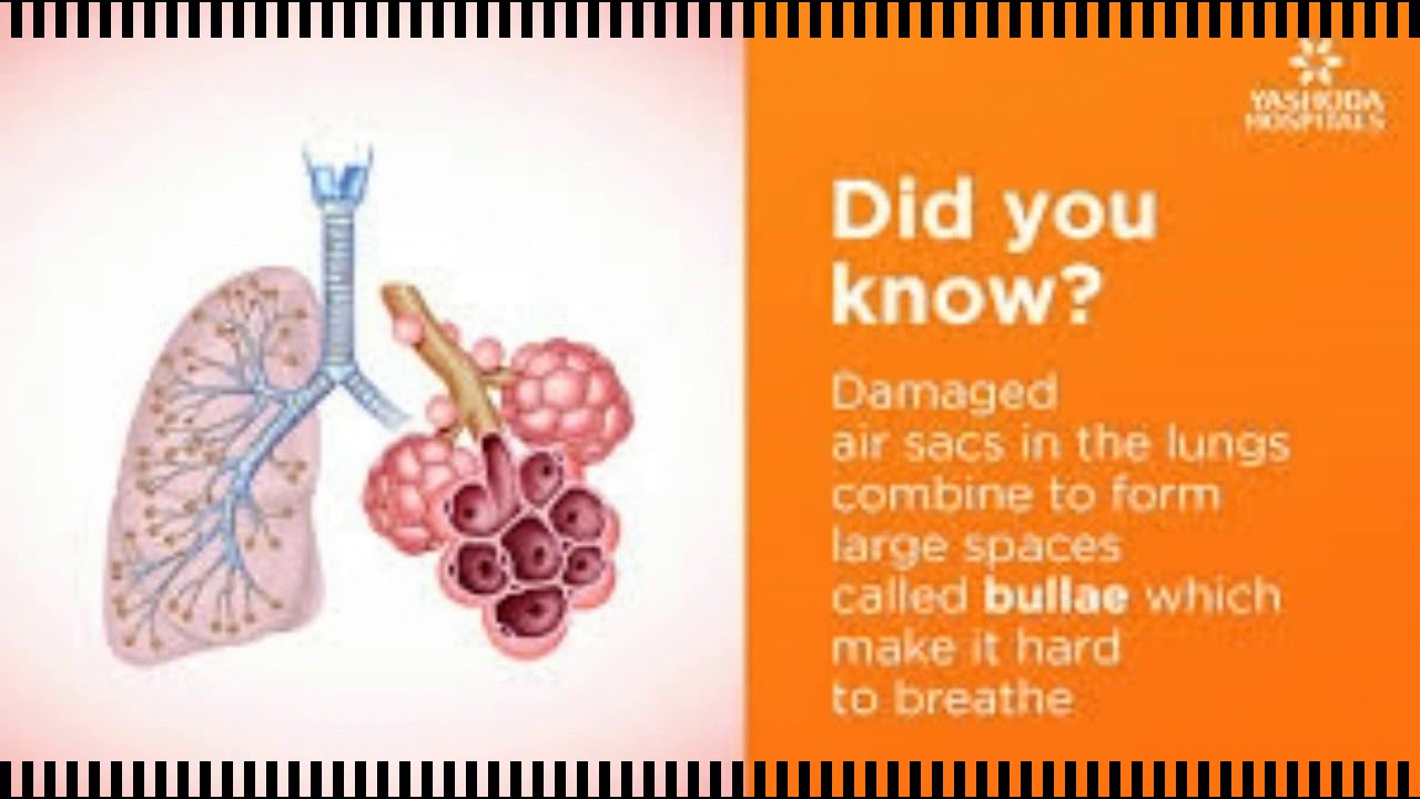 What is bullectomy surgery? Living Healthy with COPD! - YouTube