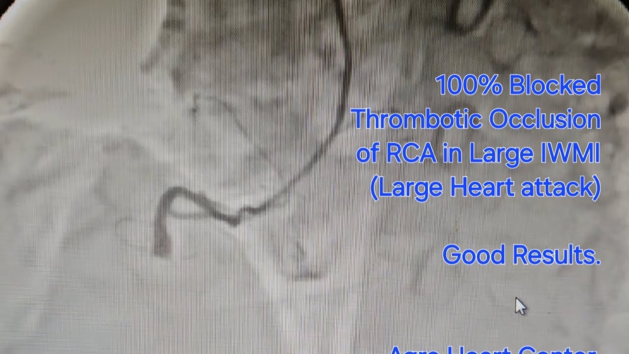 Primary Angioplasty and Stenting to 100% Blocked RCA/ Agra Heart Center ...