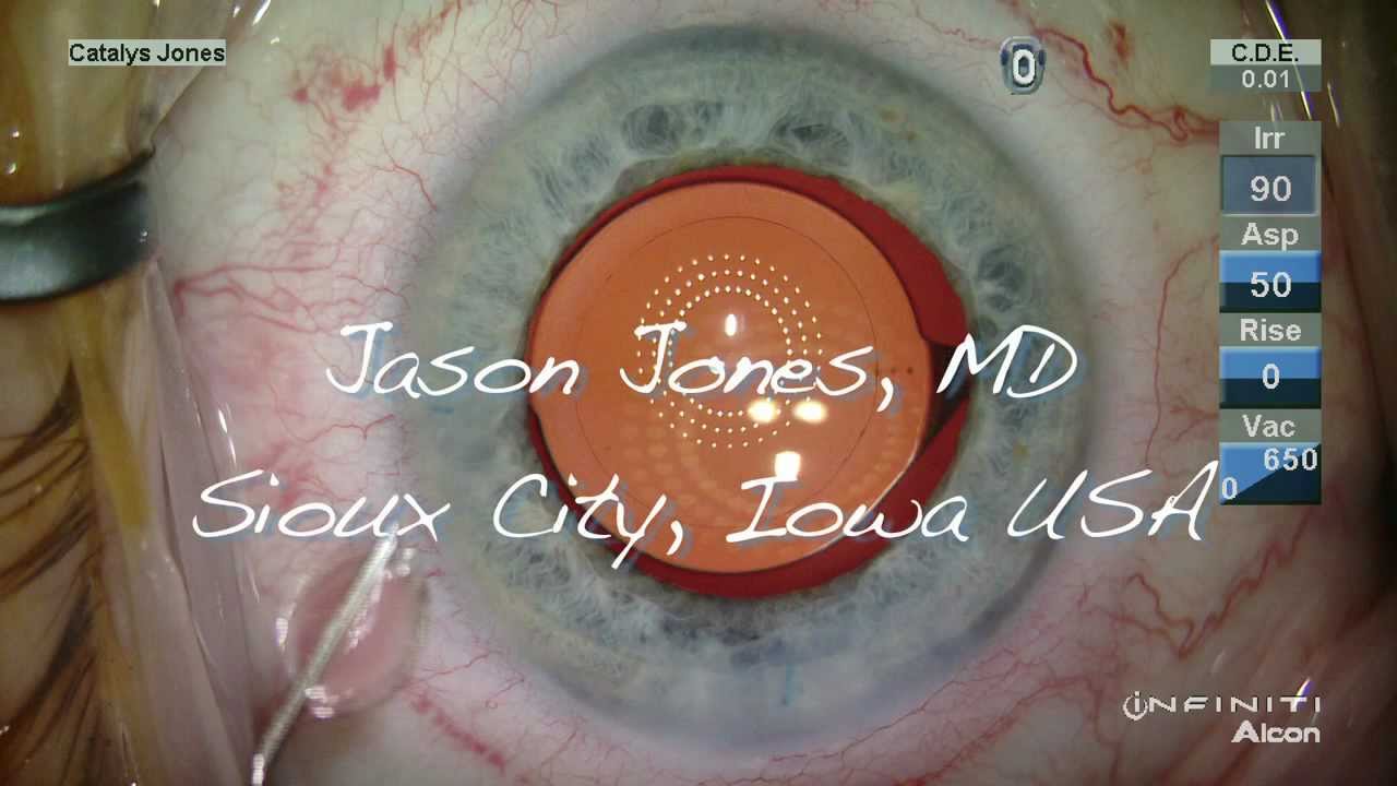 Catalys Phaco with Toric IOL - YouTube