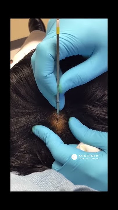 Pilar Cyst Removal On Scalp Youtube