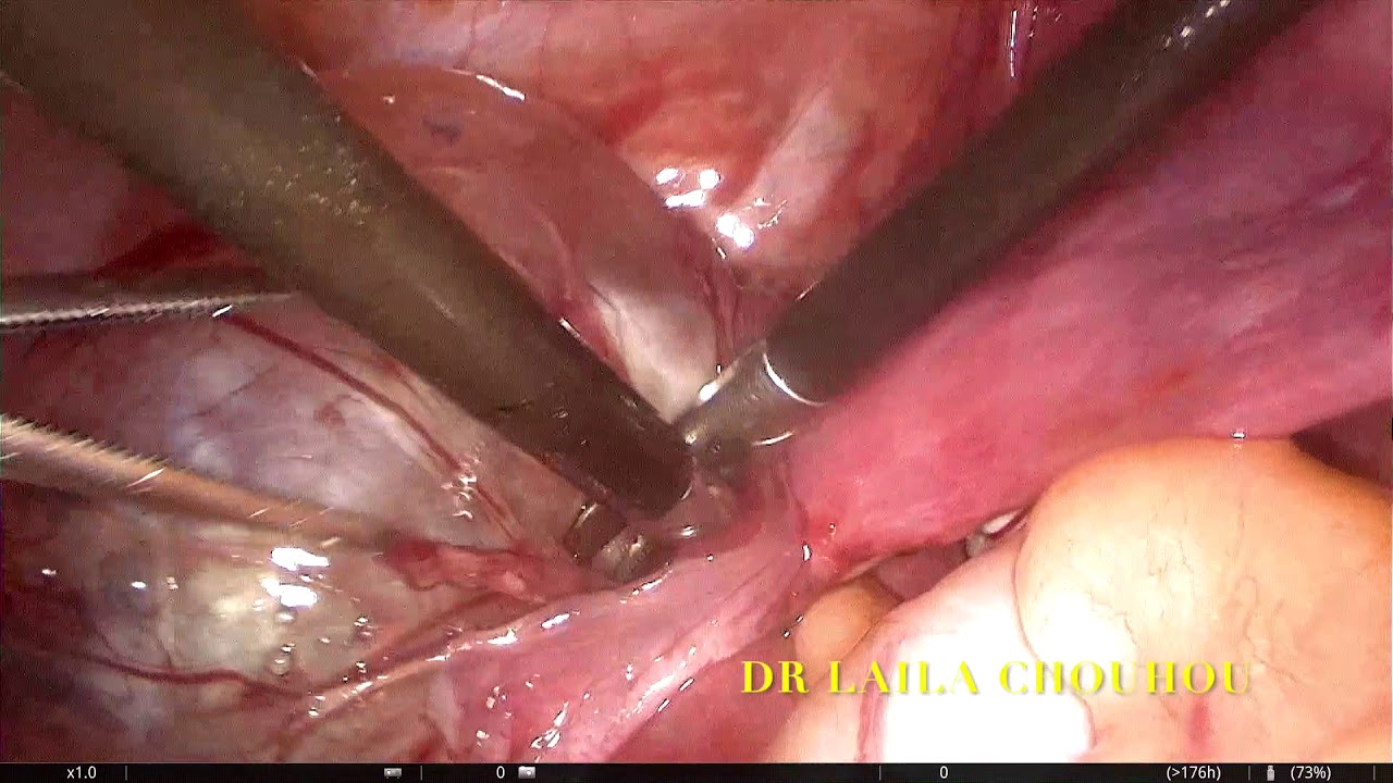 TUBAL TWIST: PARATUBAL CYST - YouTube