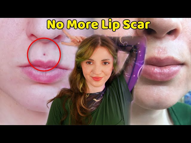 Lip Piercing Scar Healing