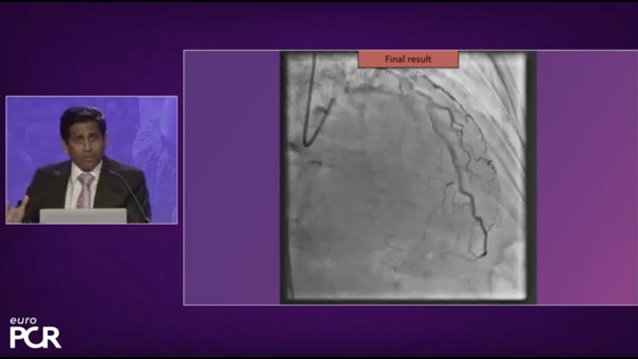 CAD treatment: sirolimus coated balloon and DES + DCB stent platform ...