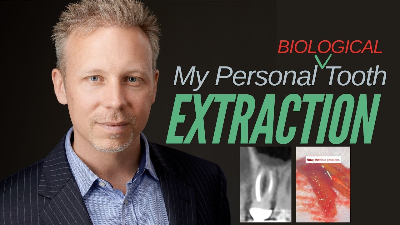 My Personal Biological Tooth Extraction With Details - Tooth #14 ROOT ...