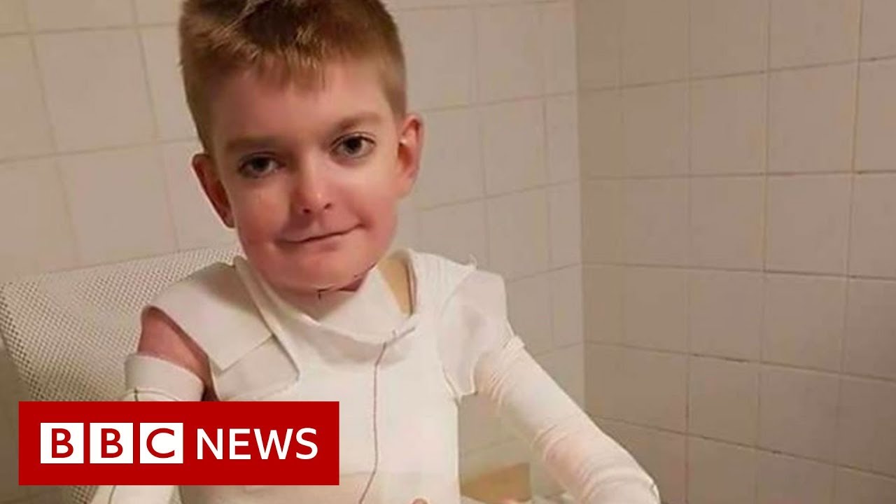 Boy with skin-peeling condition sent 18,000 cards - BBC News - YouTube