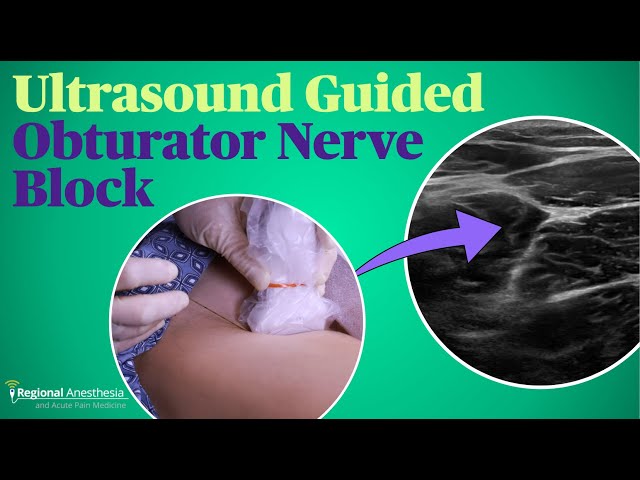 Ultrasound Guided Block Of Anterior Division Of Obturator