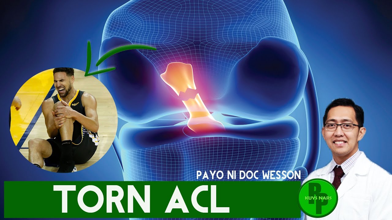 TORN ACL: Ang Injury Ng Mga Atleta! Ano Ito, Paano Nangyayari Ito ...