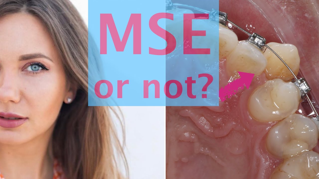 MSE or not MSE in crowding cases? Скученность зубов: расширяем? - YouTube