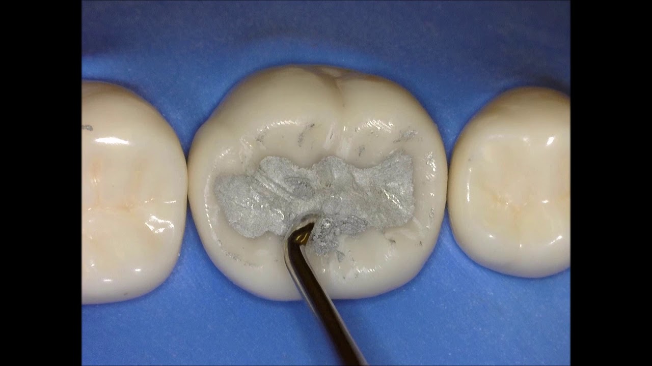 Class I Amalgam Restoration by Alex Delgado - YouTube