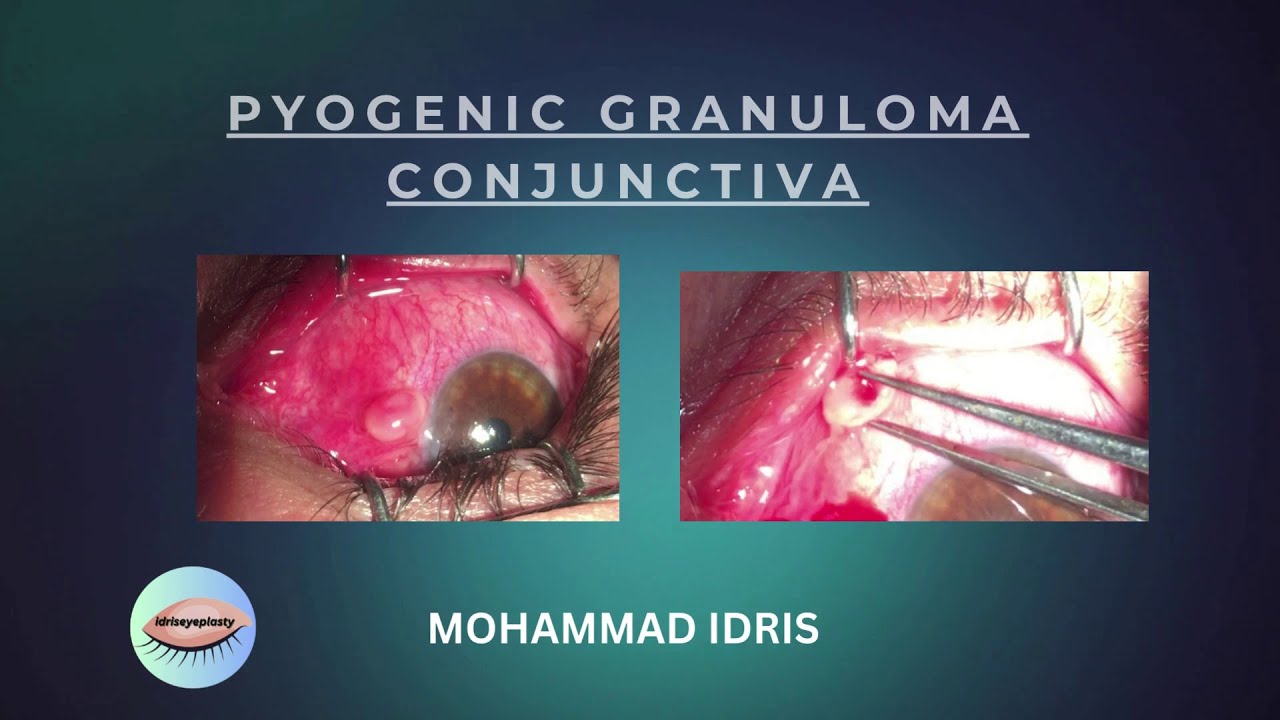 Pyogenic Granuloma of conjunctiva - YouTube