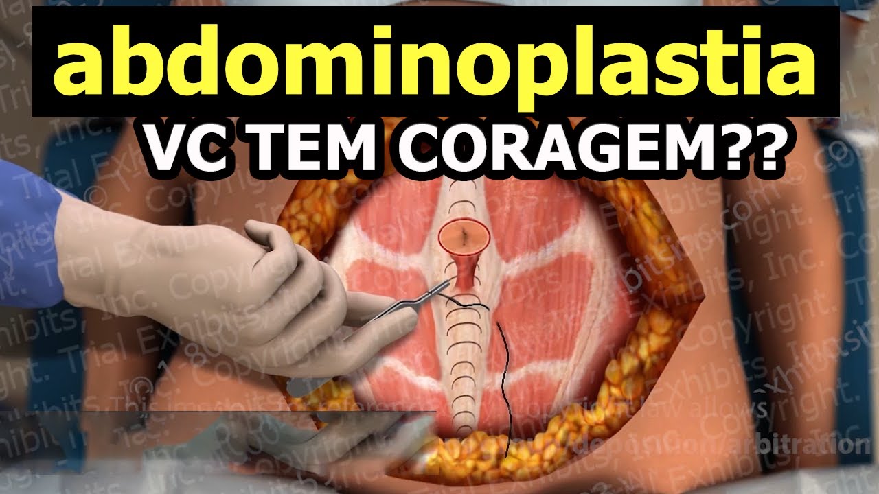 ABDOMINOPLASTIA : VOCÊ TEM CORAGEM DE FAZER ESSA CIRURGIA PLASTICA ...