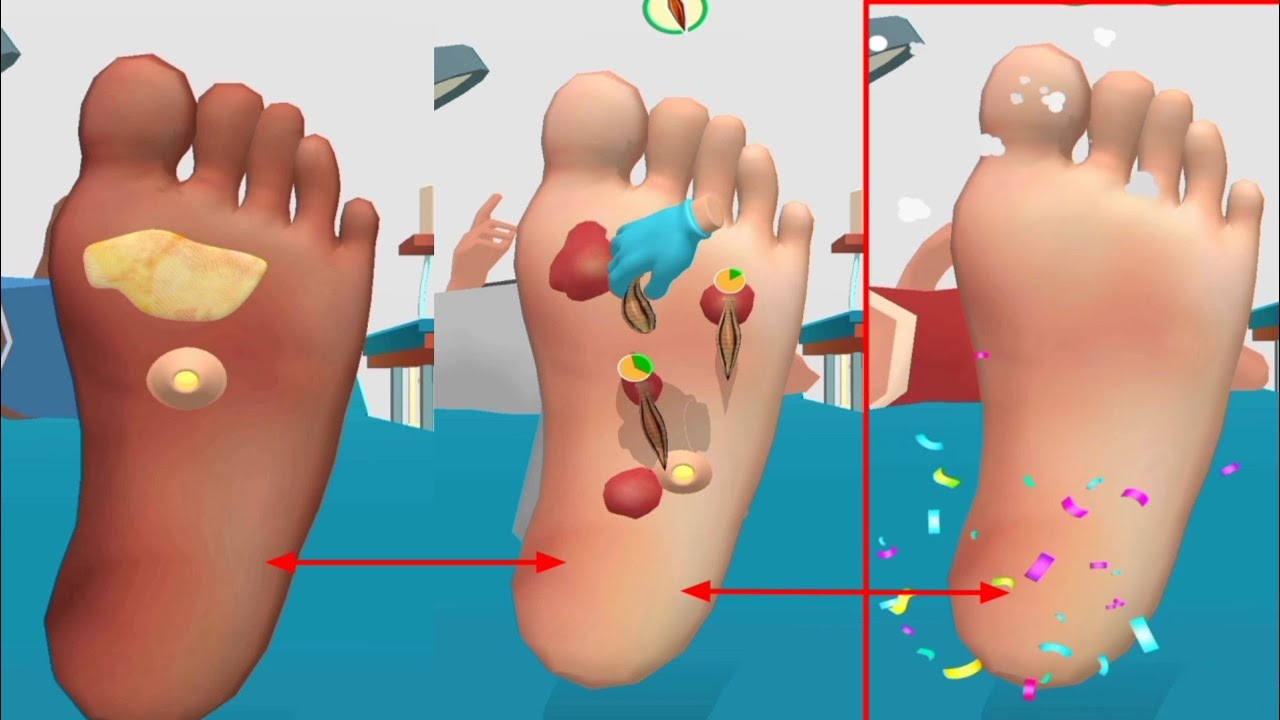 Asmr Climber's Pnantar Calluses And Root ToeNails Care Animation | Asmr ...