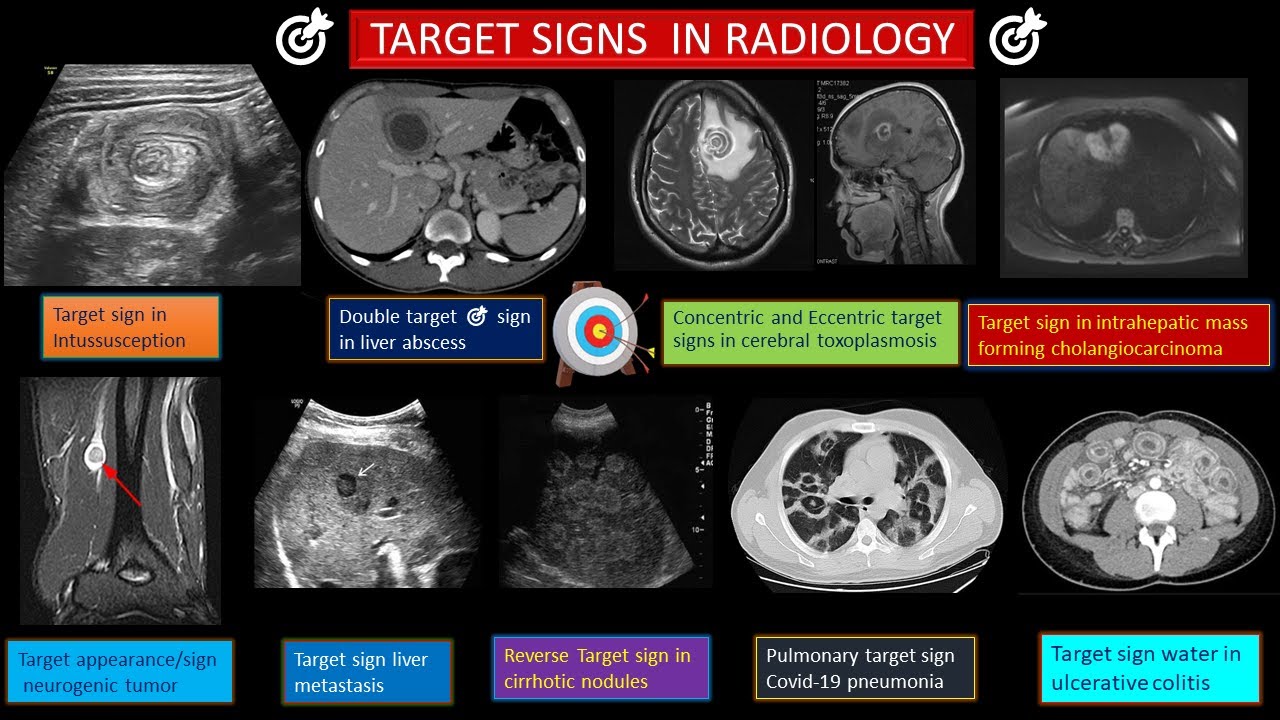 TARGET SIGNS IN RADIOLOGY - YouTube