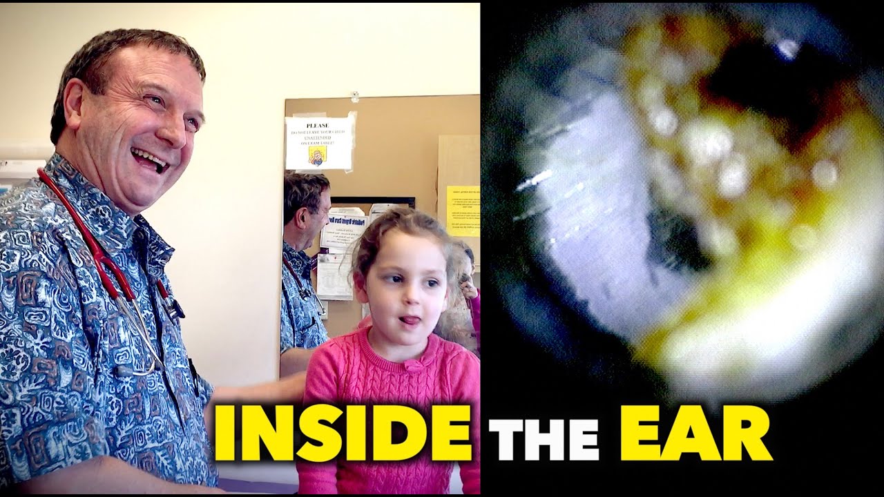 EAR WAX, EAR TUBES, & EARDRUM SCARRING! (Inside the Ear) | Dr. Paul ...