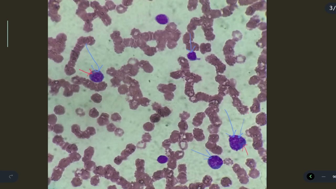 reactive lymphocyte - YouTube