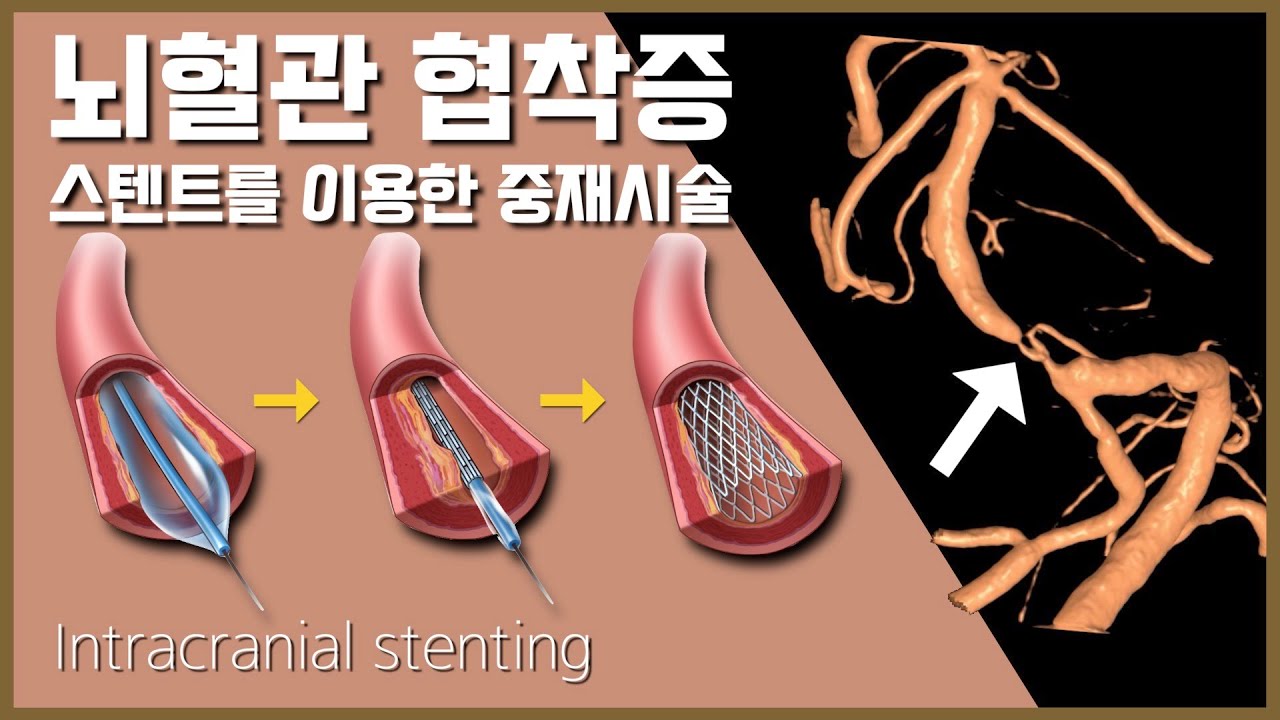 뇌혈관협착증 뇌경색 예방과 치료를 위한 뇌혈관 협착증의 풍선 확장술과 스텐트 시술 전체 시술 영상 요약 Stenting