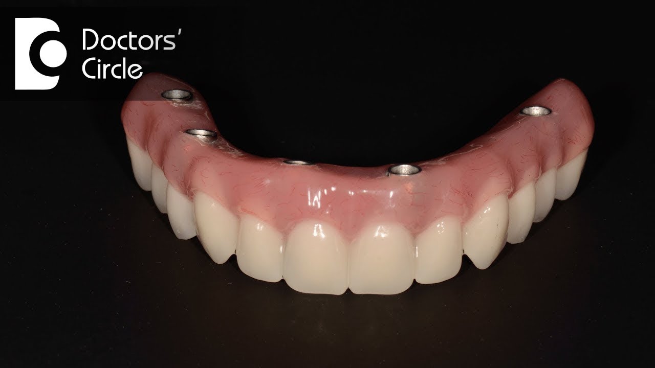 Is it necessary to remove implant supported denture in night? - Dr ...