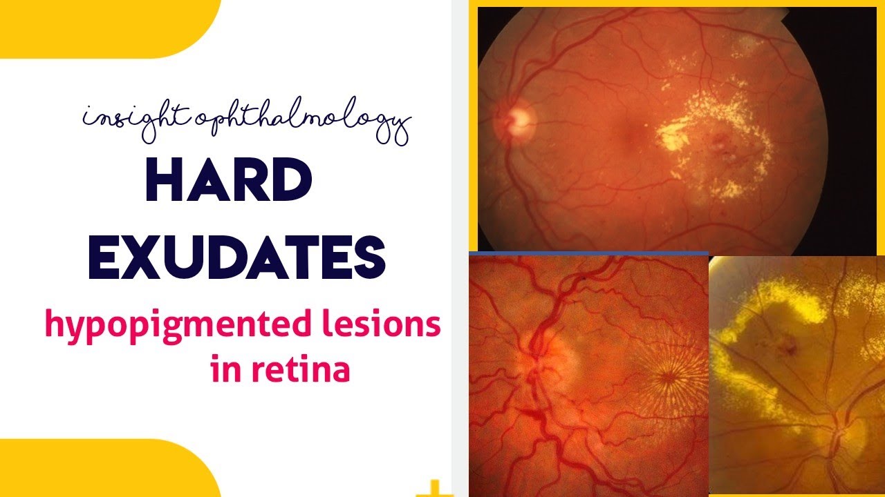 HARD EXUDATES || Hypopigmented lesions of the retina || - YouTube