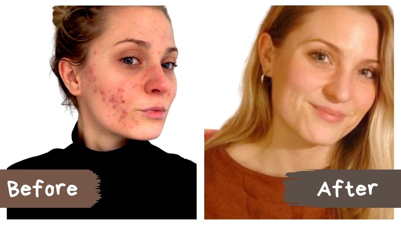 How I Finally Healed my Acne (And how you can too) - YouTube