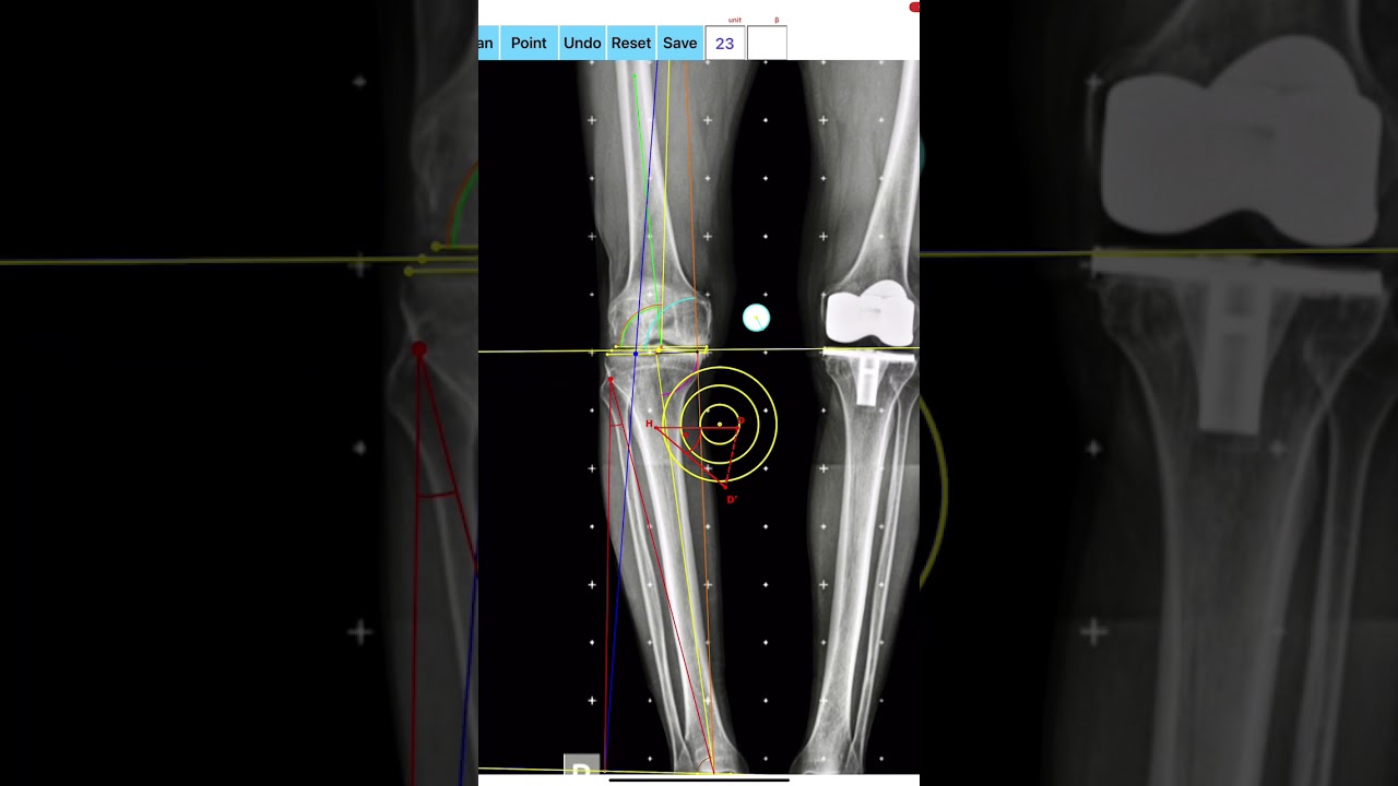 How to measure and planning osteotomy with Osteotomyapp - YouTube