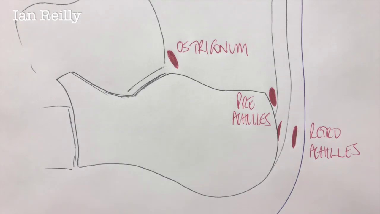 Injection - pre Achilles bursitis CSI injection (another patient) - YouTube