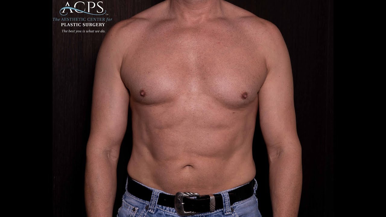 7 Years Post-Op Ab Etching - YouTube