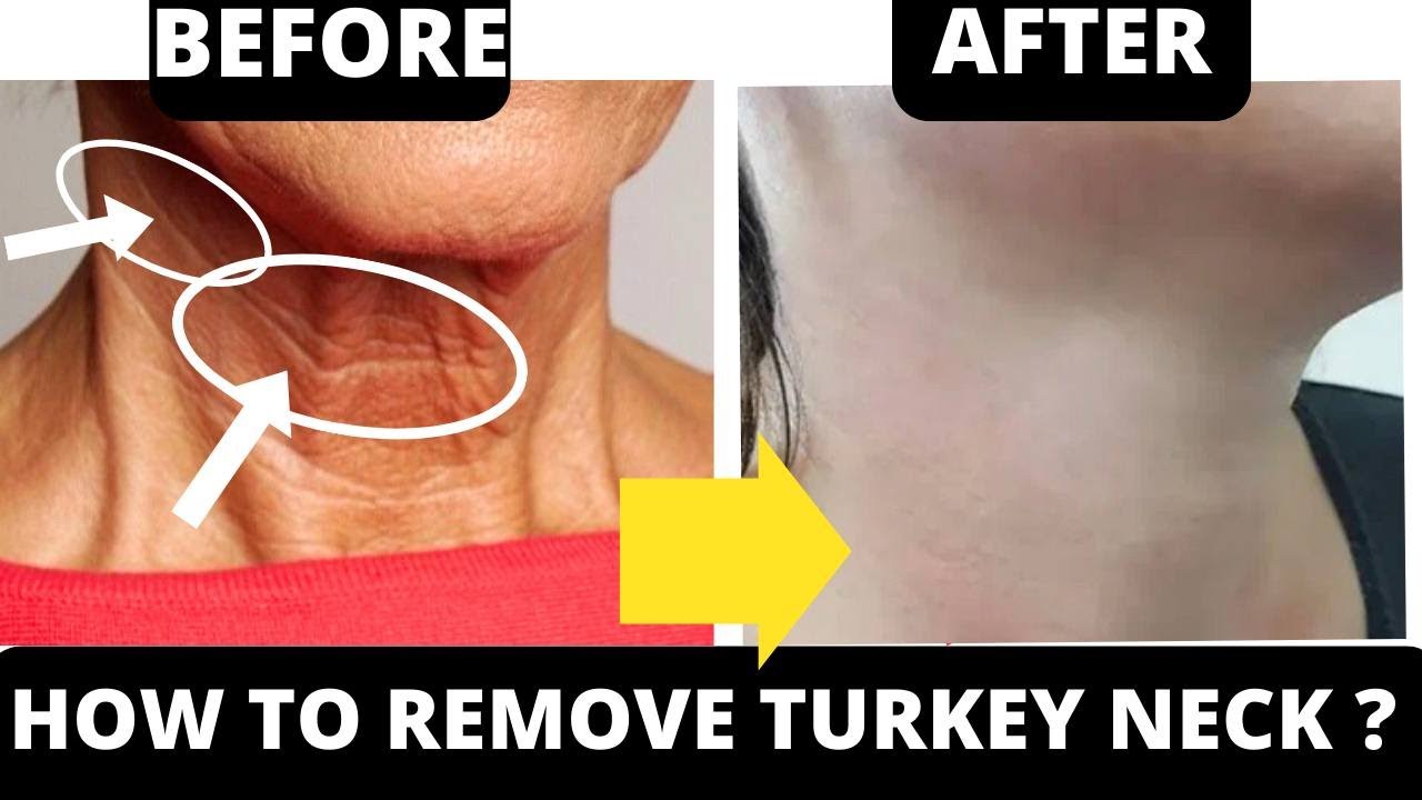 🛑 STOP TURKEY NECK and NECK WRINKLES ! ANTI-AGING EXERCISES FOR NECK ...