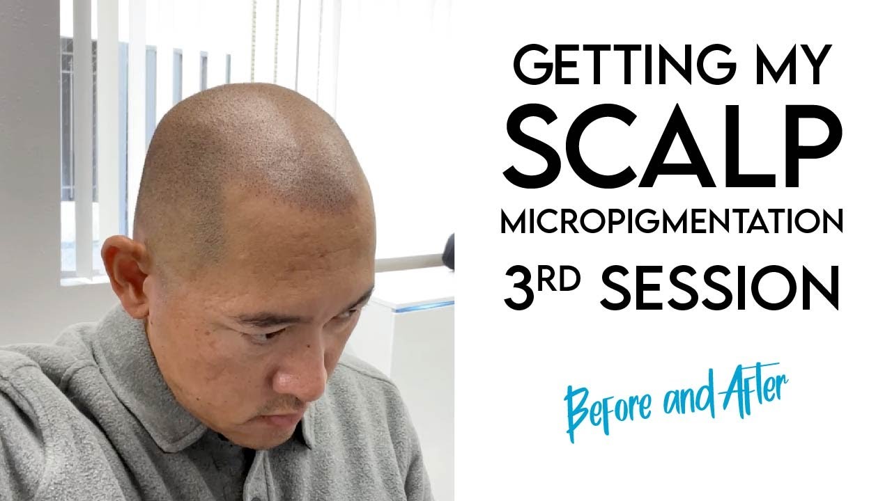 Getting My Scalp Micropigmentation (SMP) | 3rd Session - YouTube