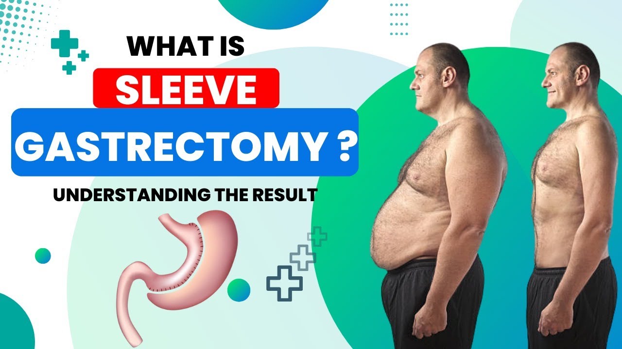 Laparoscopic Sleeve Gastrectomy for Weight Loss - Procedure, Side ...