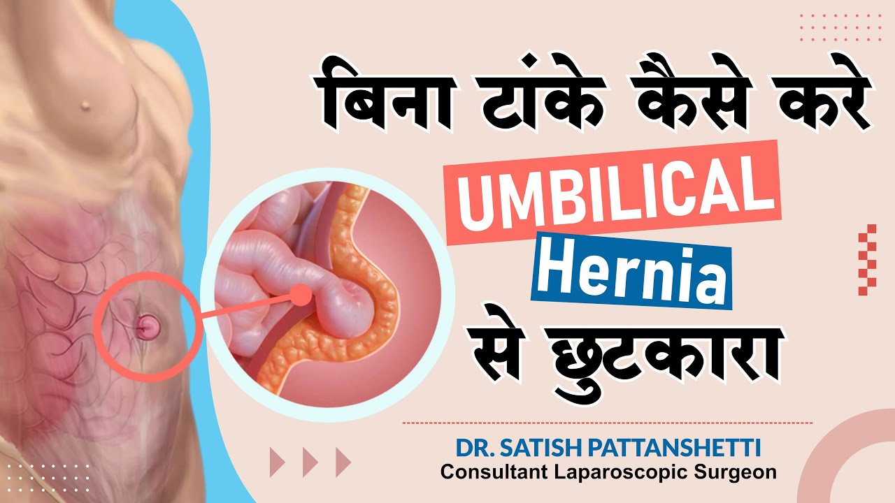 Anatomy Of Umbilical Hernia Abdominal Hernias: Practice Essentials,