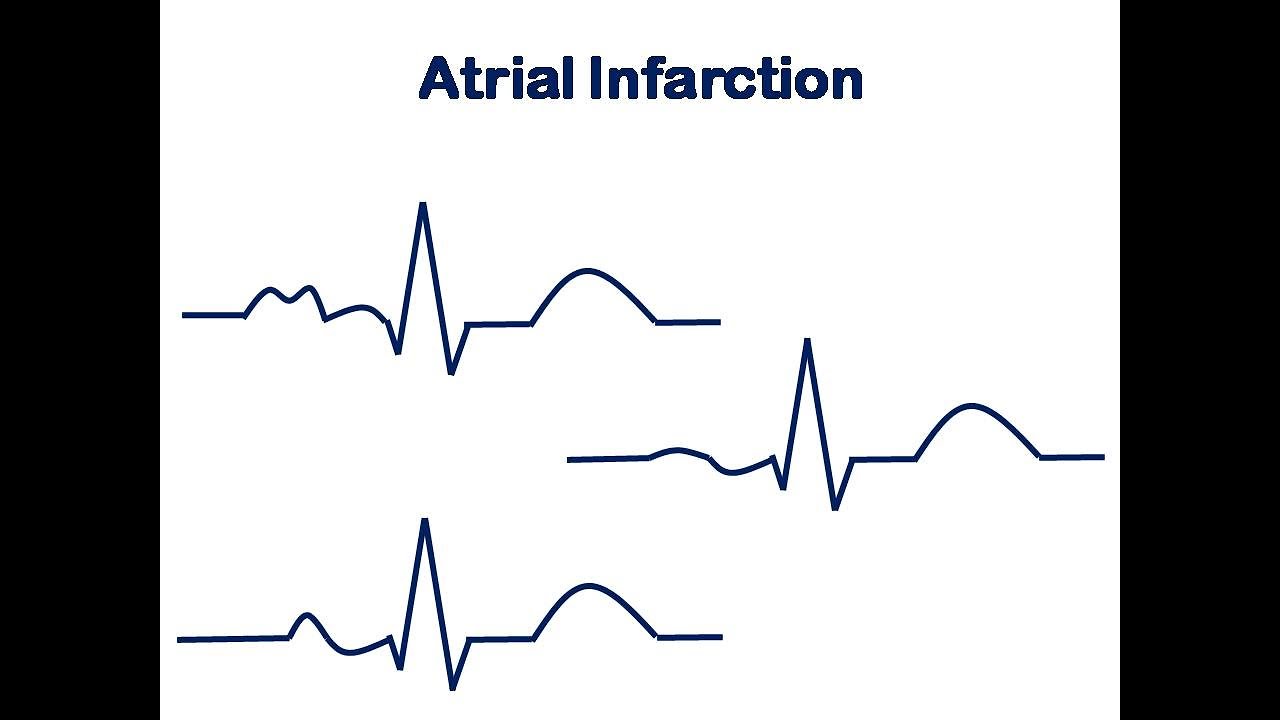 ECG course: Atrial Infarction, ECG course - YouTube