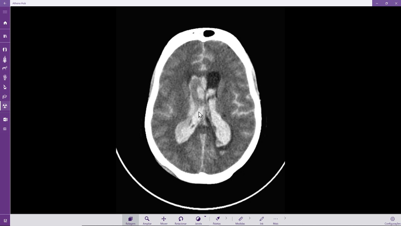 Hemorragia subaracnóide - YouTube