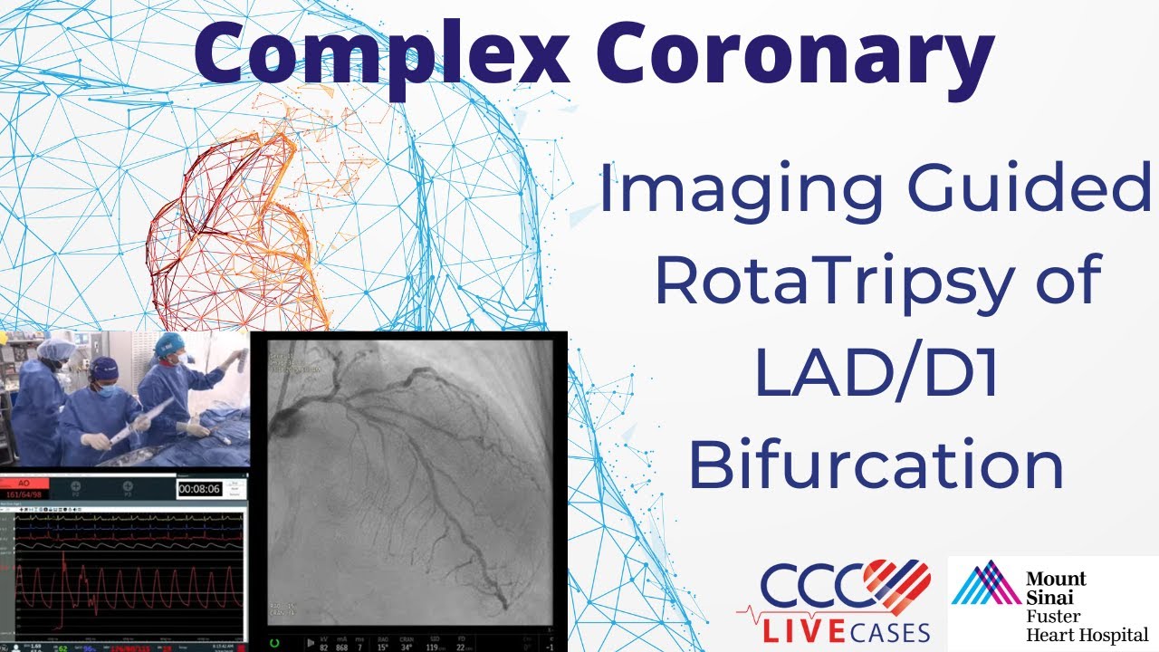 Imaging Guided RotaTripsy of LAD/D1 Bifurcation - YouTube