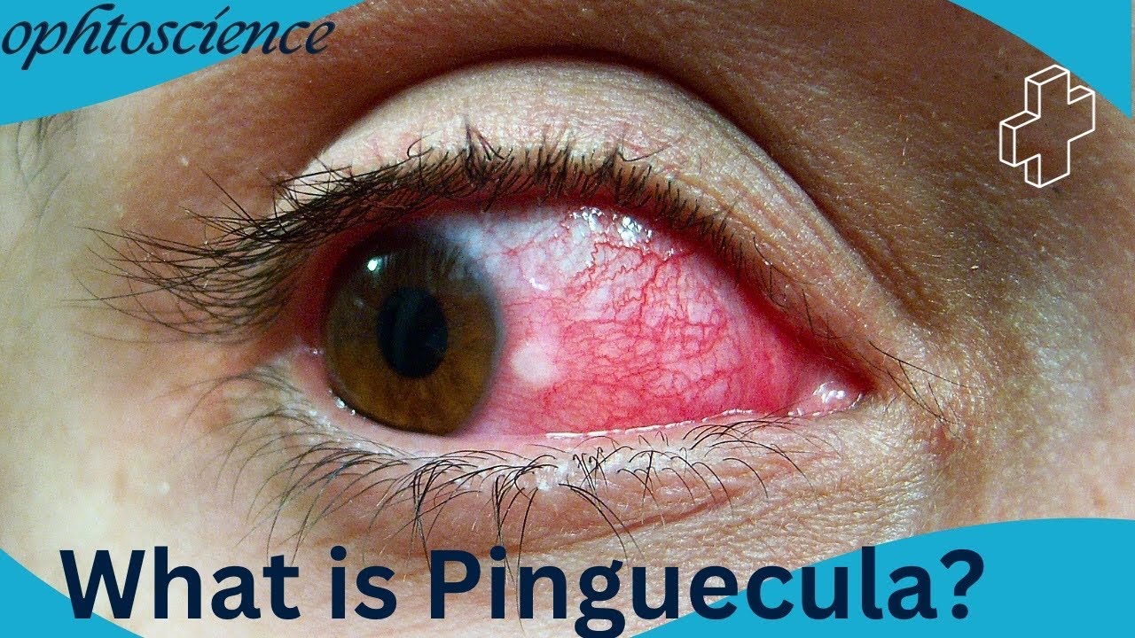 what is pinguecula? |symptoms, sign, treatment, preventions - YouTube
