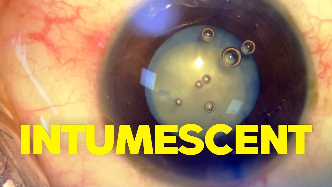 Cataract Surgery | Intumescent cataract | Mid dilated pupil | IOL ...