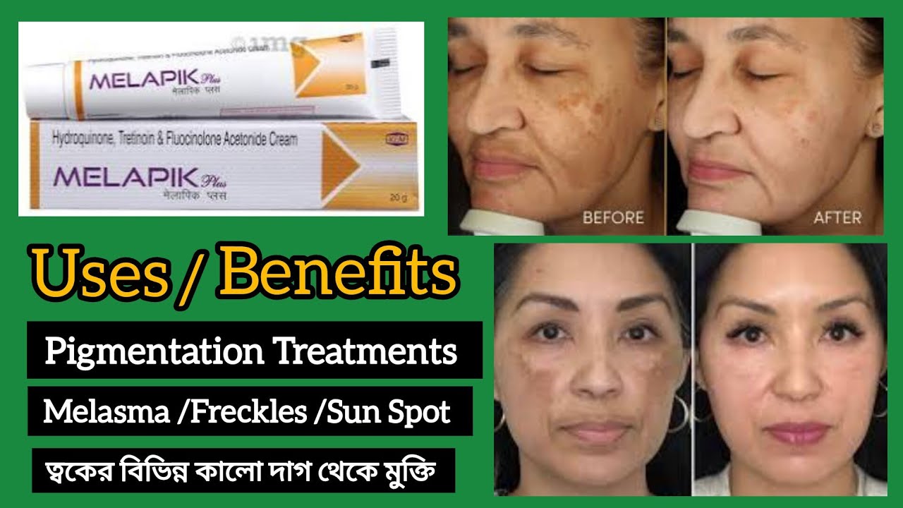 Melapik Plus Cream | Hydroquinone, Tretinoin, Fluocinolone Cream ...