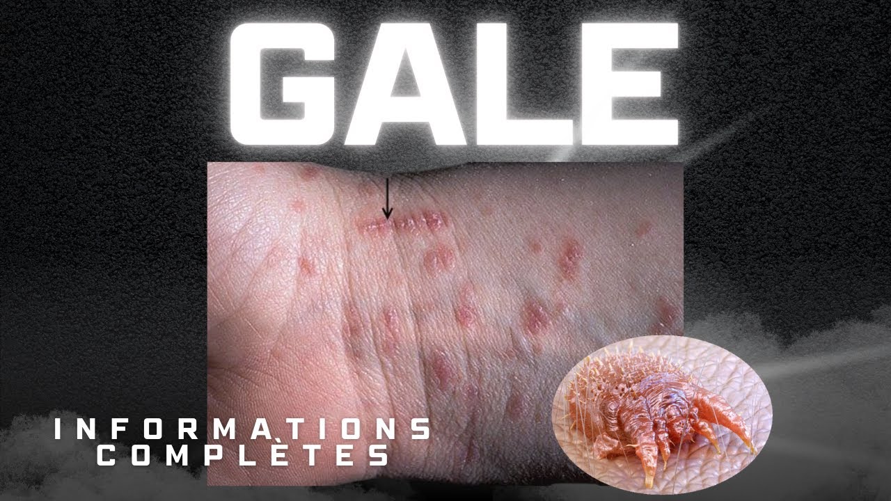 La gale expliquée | Symptômes, causes, traitement et prévention - YouTube