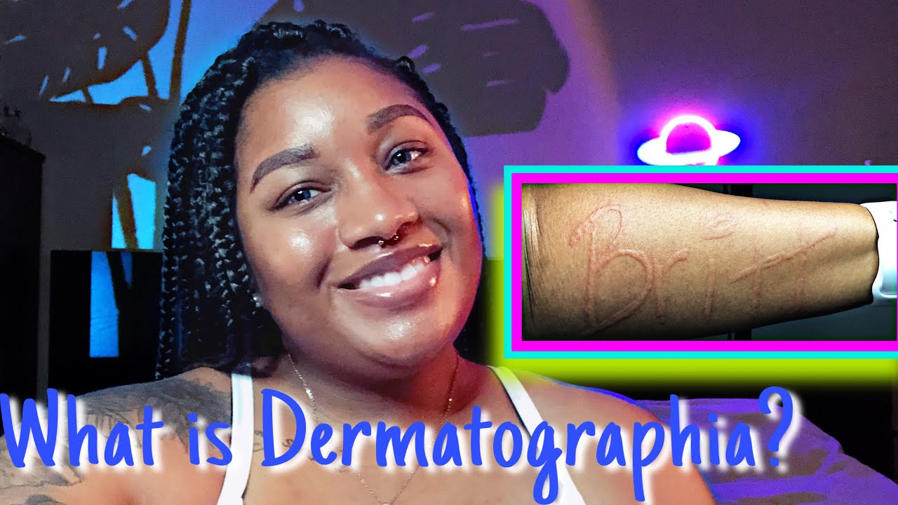 What is Dermatographia | Living with it | help ease it #Dermatographism ...