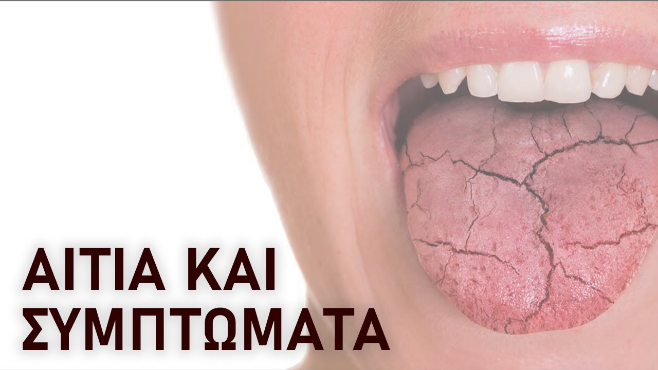 Φλεγμονή στη γλώσσα: Όσα πρέπει να γνωρίζετε - YouTube