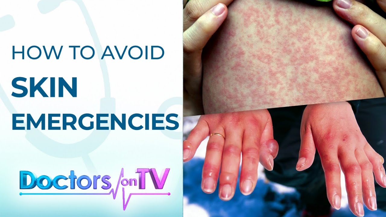 Keeping a Healthy and Happy Skin to avoid Skin Emergencies | DOTV - YouTube