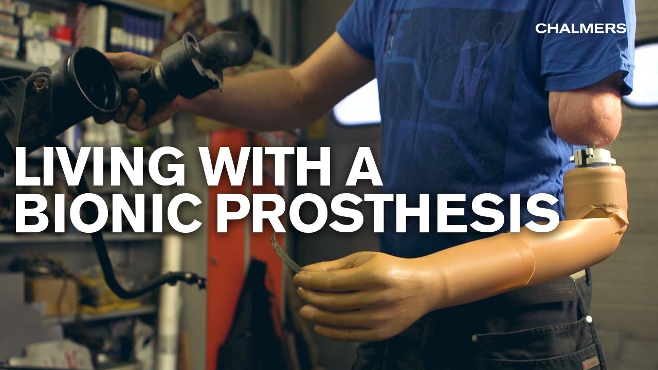 Living with a bionic prosthesis - YouTube