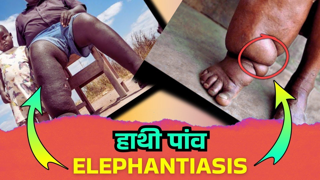 Elephantiasis class 12 biology | Human Health and Diseases | hathi panv ...