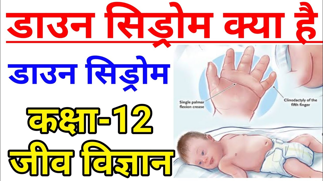 डाउन सिड्रोम | Down Syndrome kya hai | What is Down Syndrome | Class 12 ...